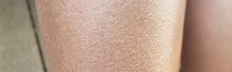 Epilyt Lotion for Dry Skin | Canada Drugs Direct